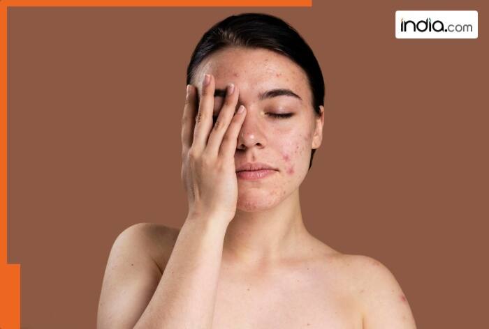 Woke up with a pimple? Try these 7 instant fixes to clear it fast
