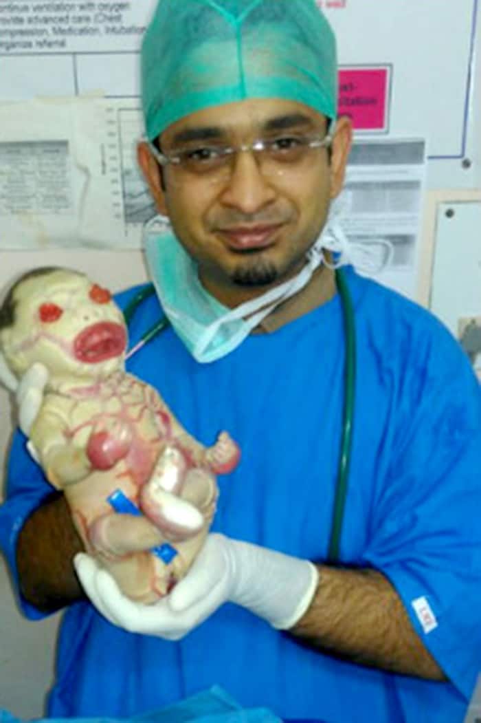 A baby girl born with Harlequin Ichthyosis syndrome died in Nagpur