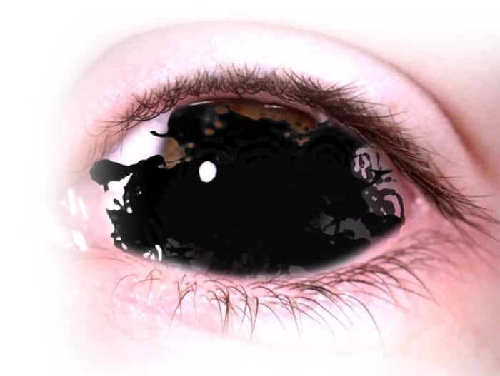 Black Fungus: Understanding Early Symptoms, Treatment And Prevention