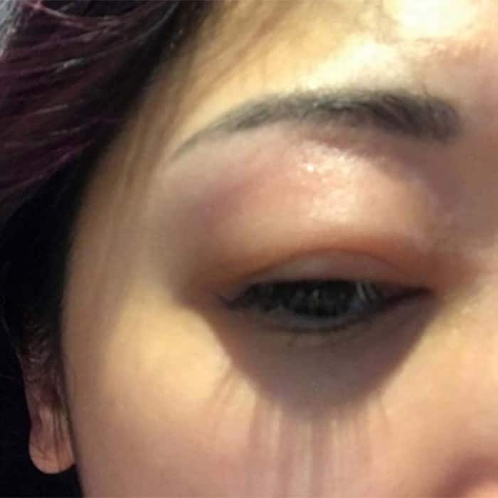 6 Common Eye Infections That Can Happen in Monsoon & How to Prevent Them