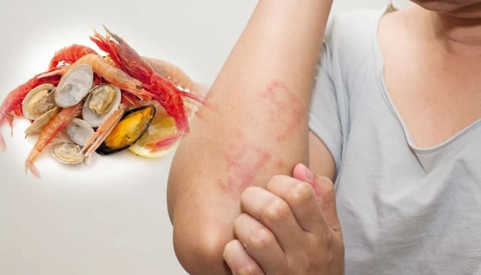 Shellfish allergy