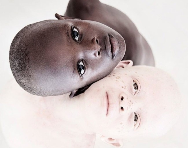 International Albinism Awareness Day 2020: Eye Conditions That Are ...