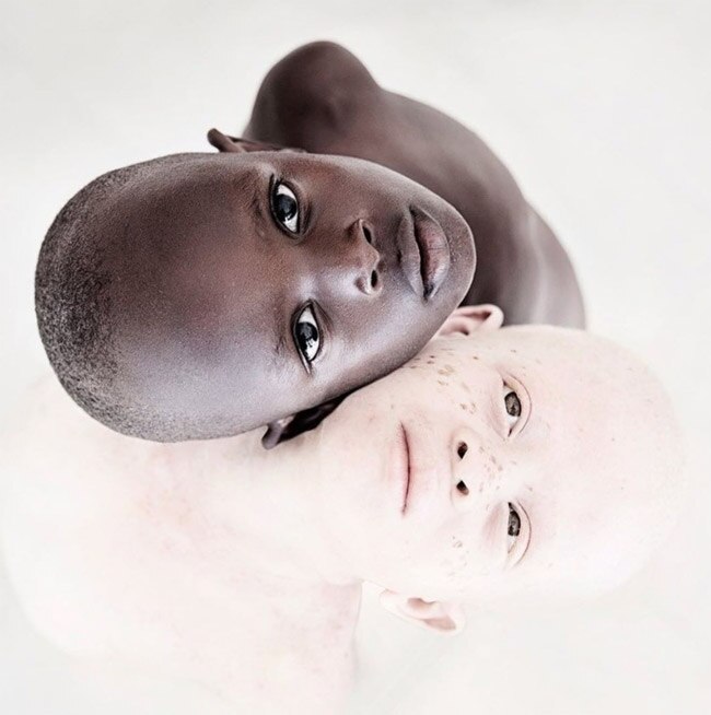 International Albinism Awareness Day 2020: Eye Conditions That Are ...