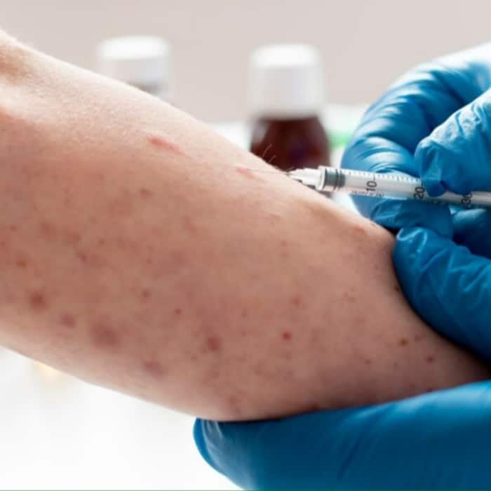 Mpox Cases on Rise: Vaccine to First Symptoms, 6 Essential Things to ...