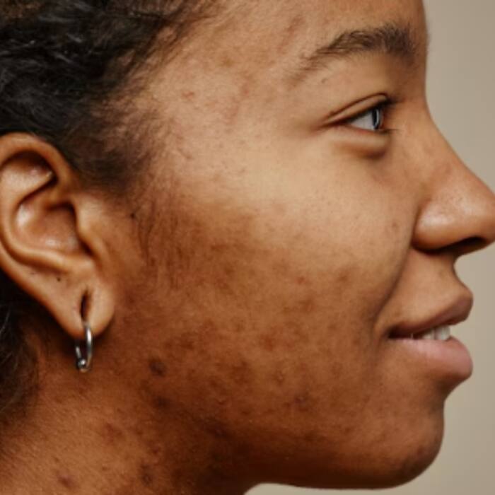 7 early signs of PCOS every woman should know