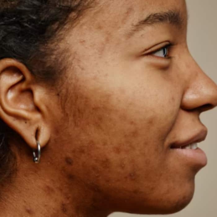 7 silent symptoms of hormonal imbalance you should not ignore