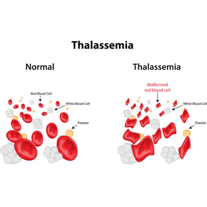 World Thalassemia Day: 7 facts about cause, symptoms, diagnosis and ...